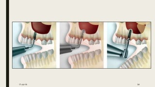 "Sinus Lift in Implant Dentistry" | PPTX