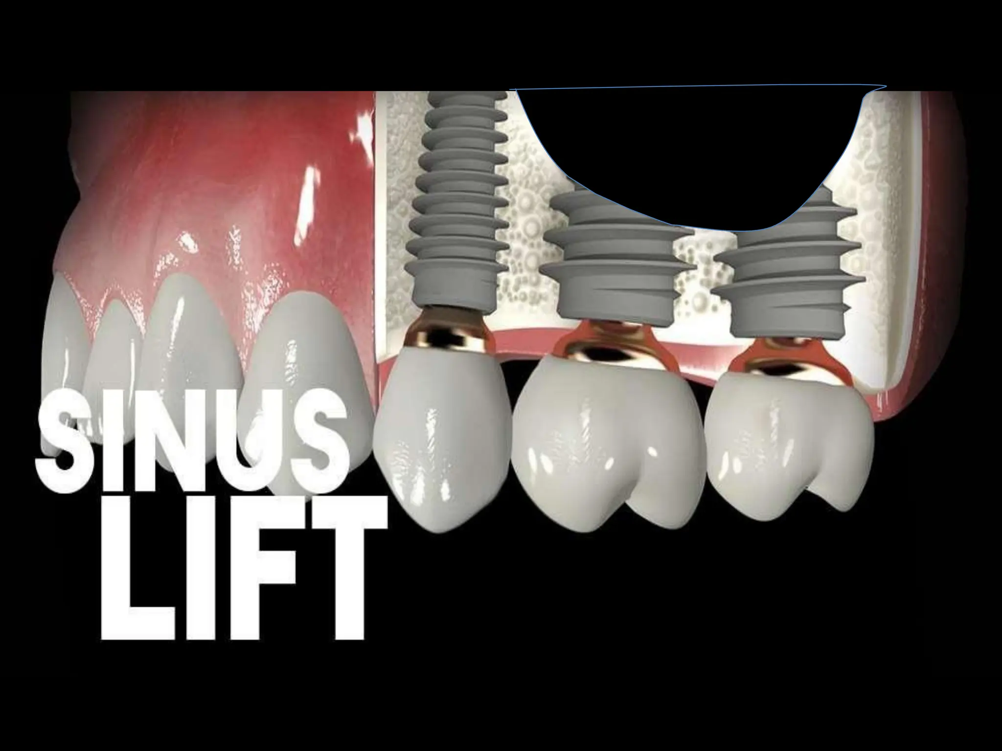 Sinus Lift ppt about maxillary sinus lift | PDF