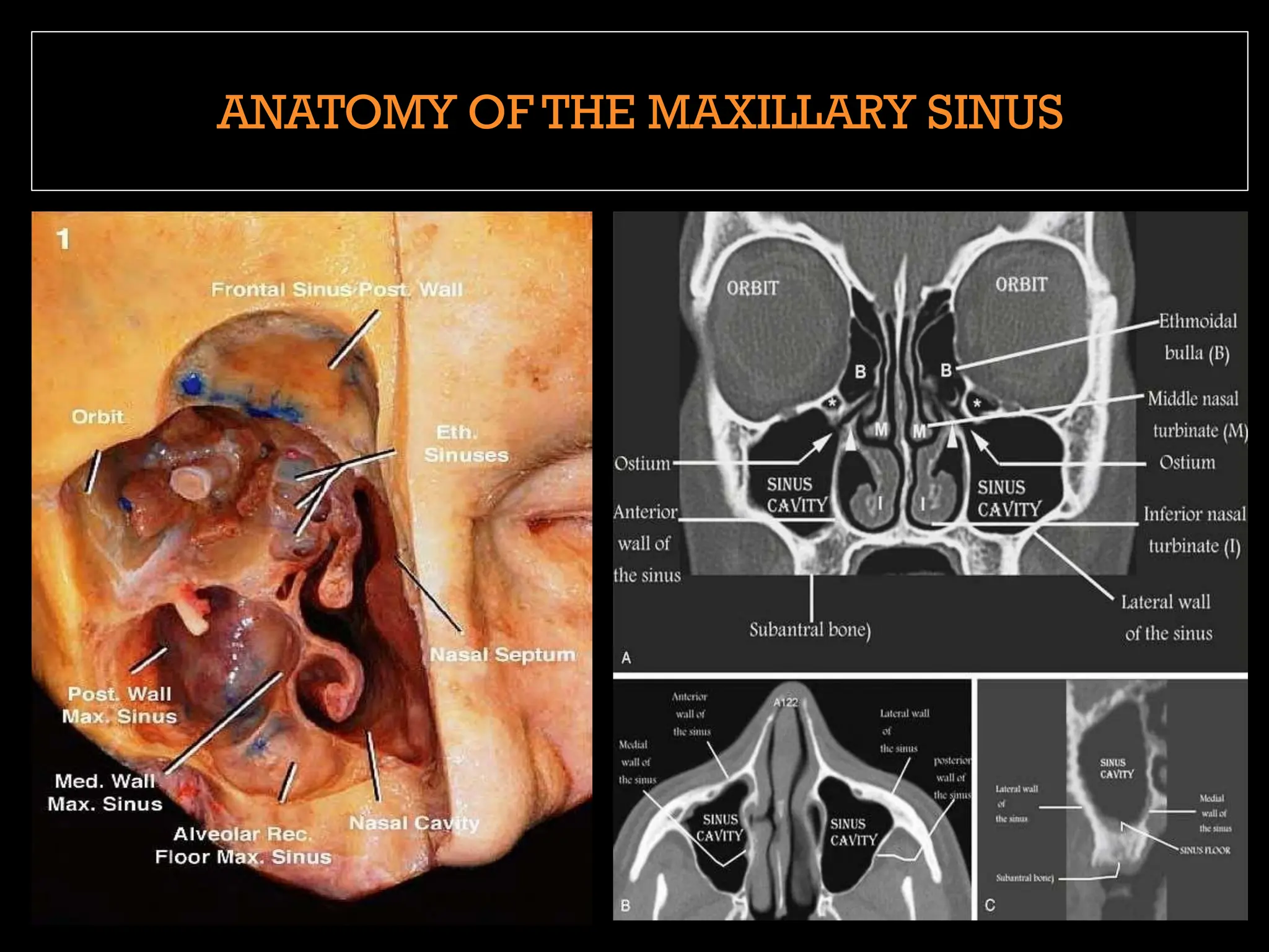 Sinus Lift ppt about maxillary sinus lift | PDF