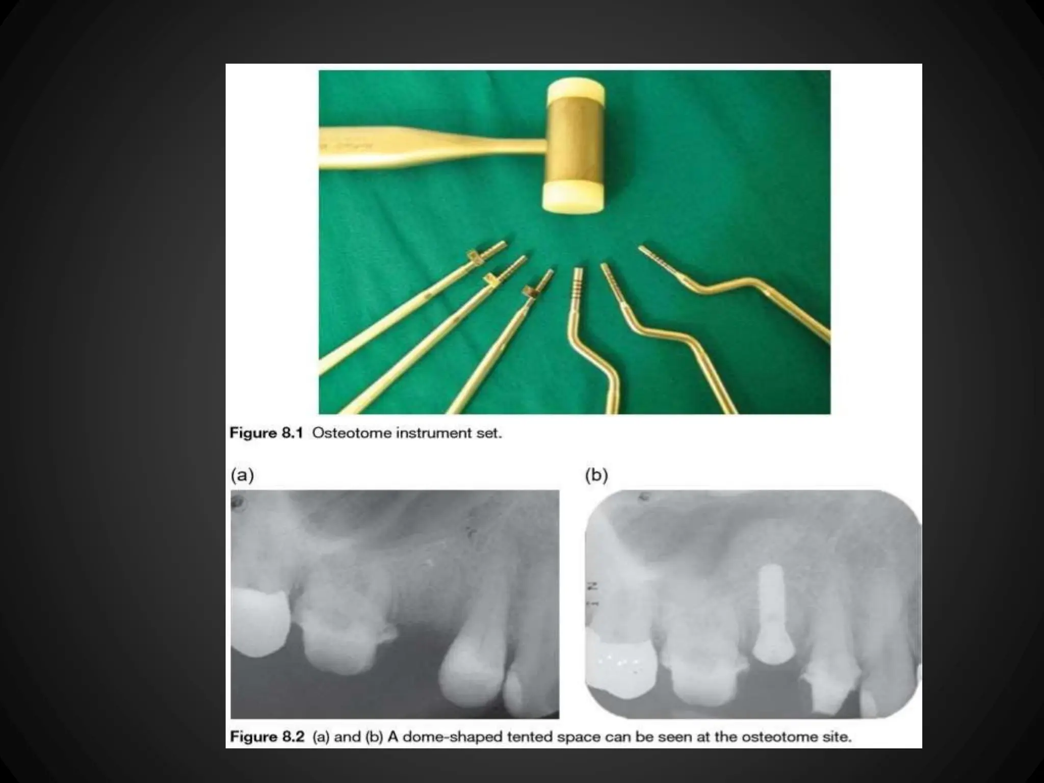 Sinus Lift ppt about maxillary sinus lift | PDF