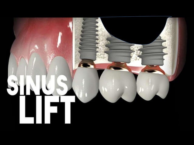 Sinus Lift ppt about maxillary sinus lift | PDF