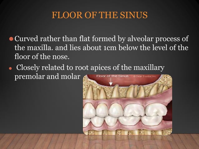 Sinus Lift ppt about maxillary sinus lift | PDF