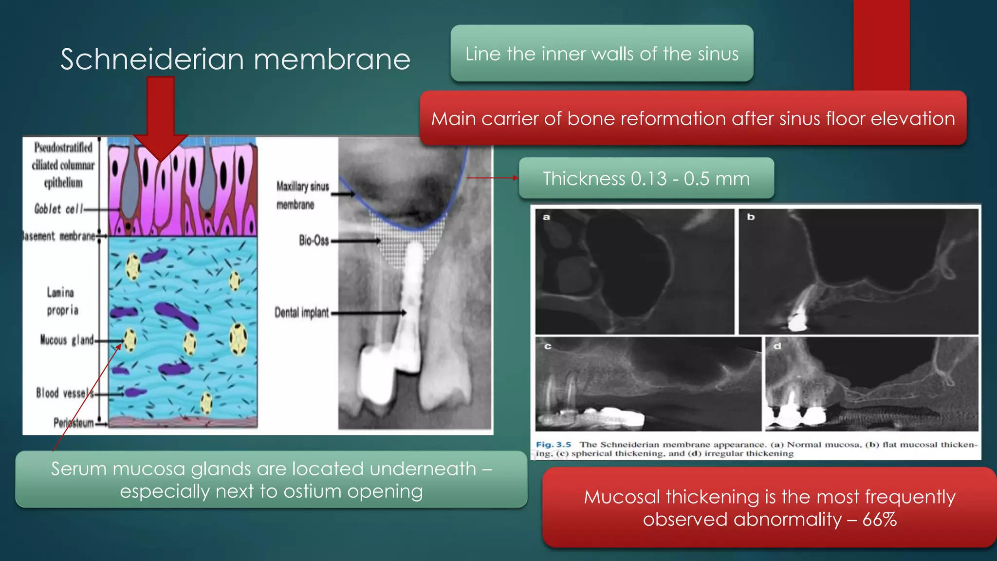 Sinus lift procedures.pptx