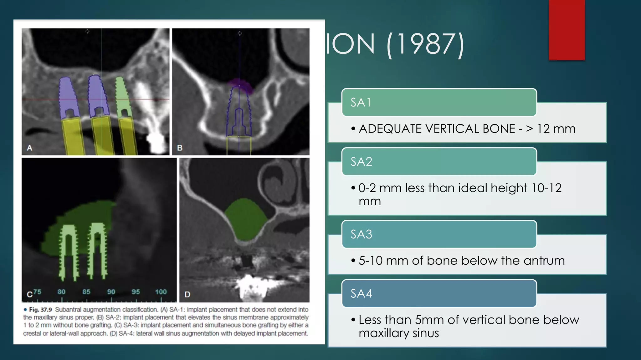 Sinus lift procedures.pptx