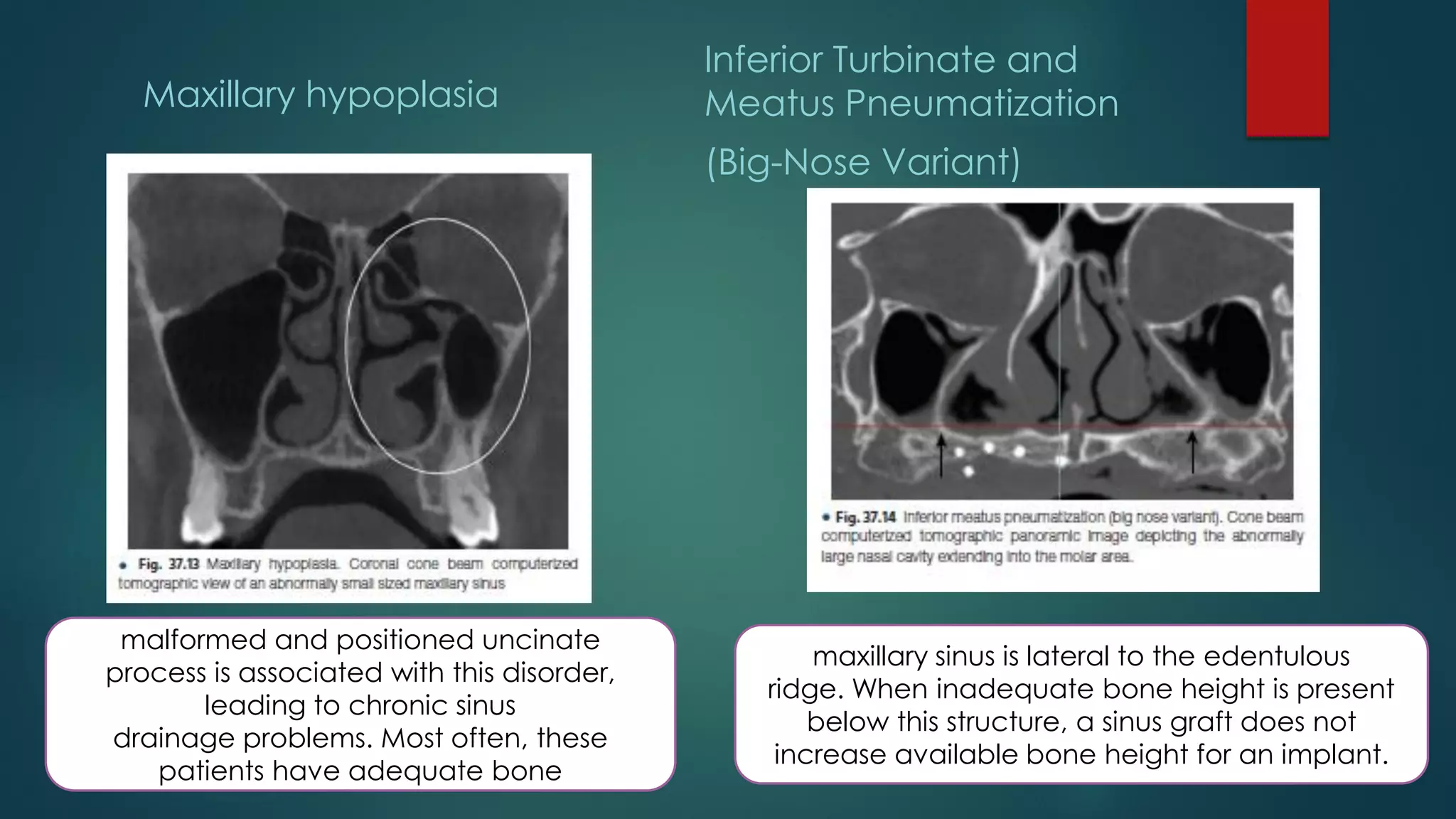 Sinus lift procedures.pptx