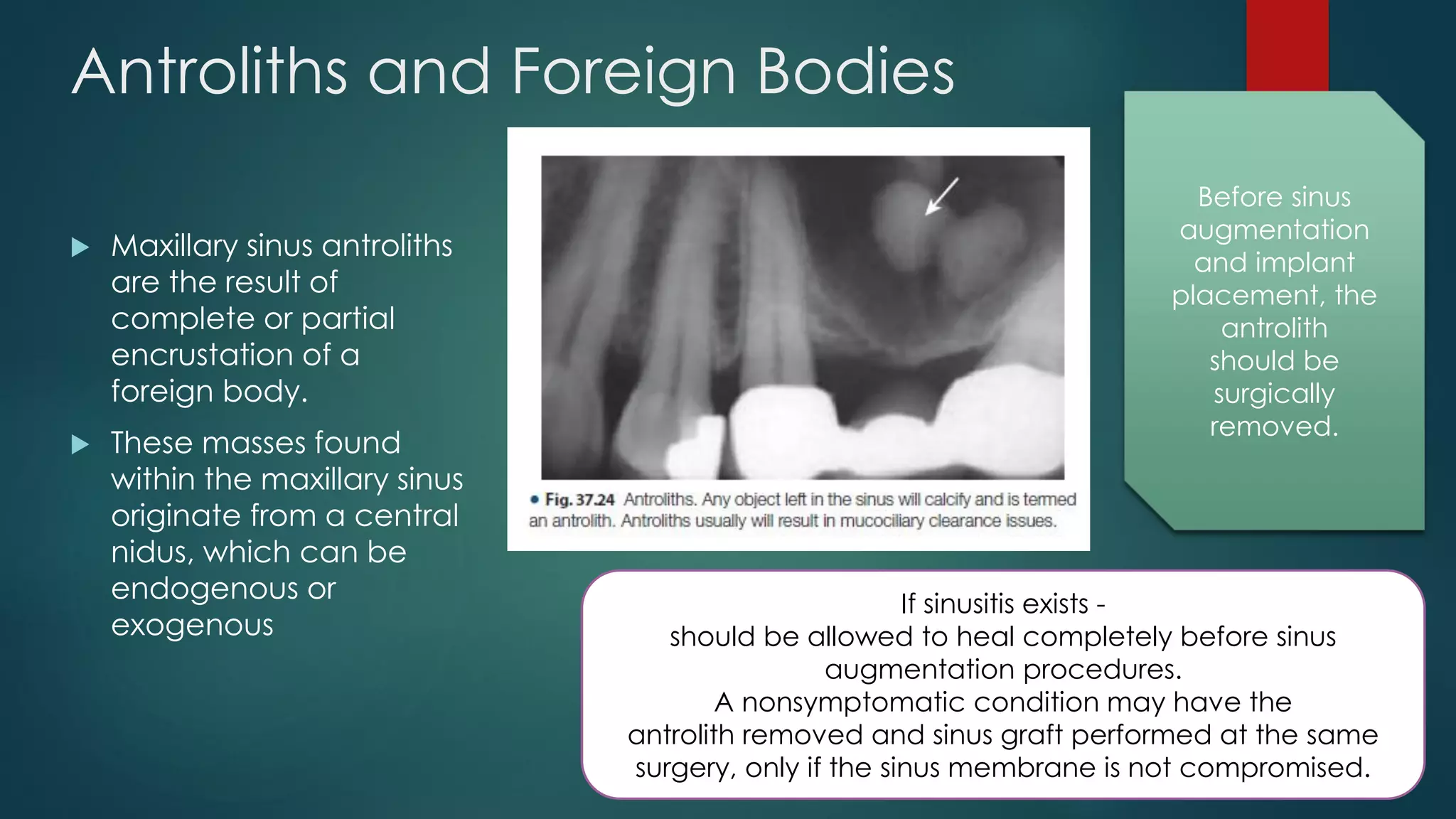 Sinus lift procedures.pptx