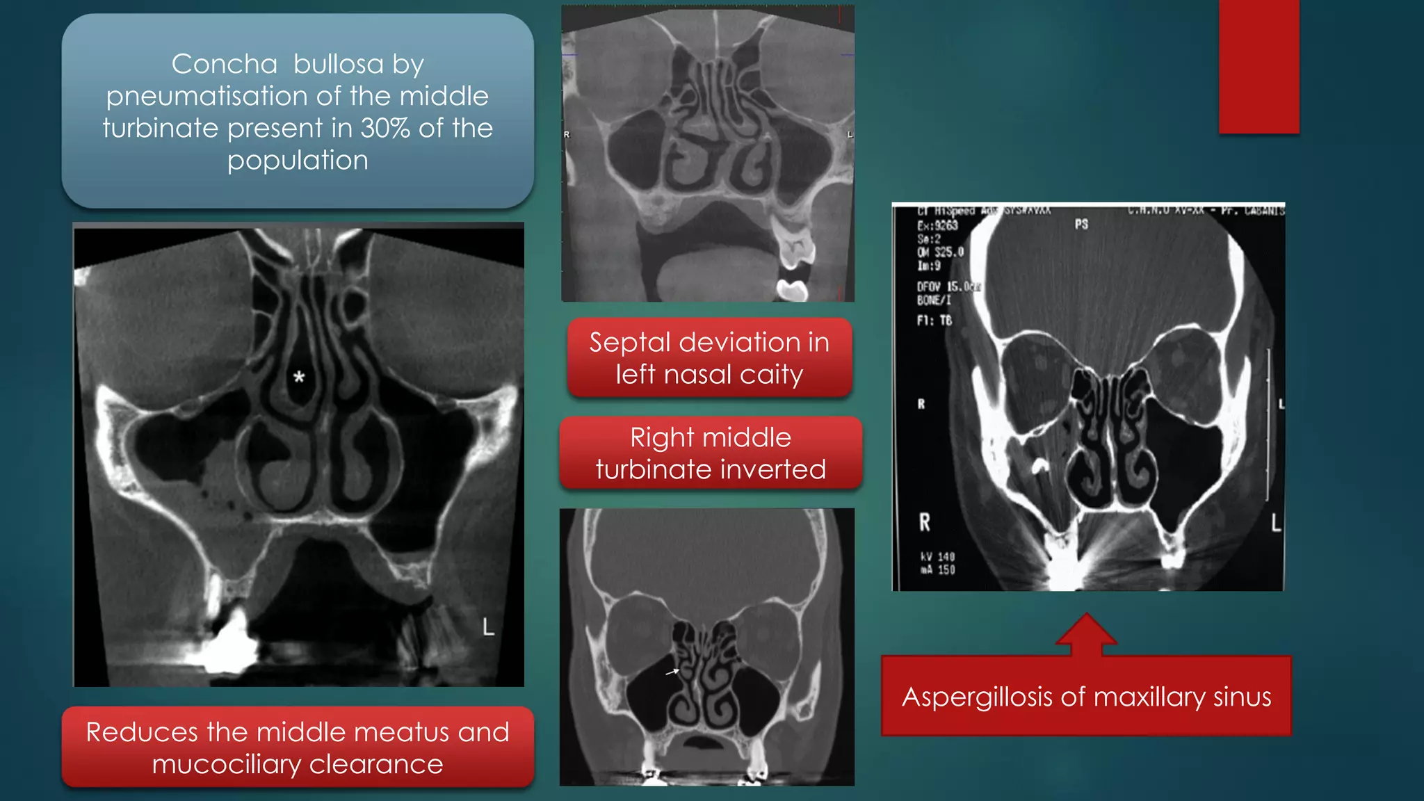 Sinus lift procedures.pptx