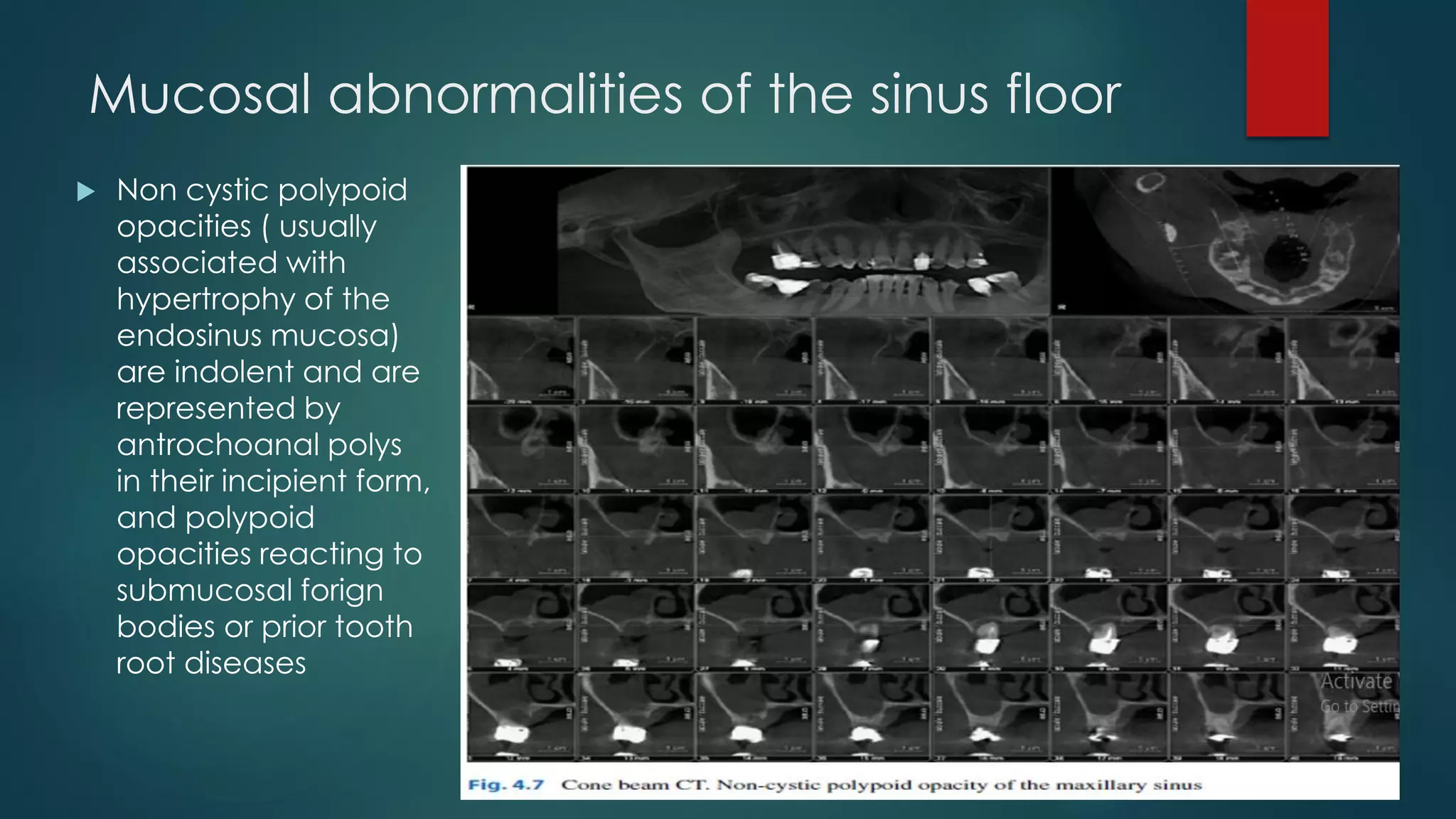 Sinus lift procedures.pptx