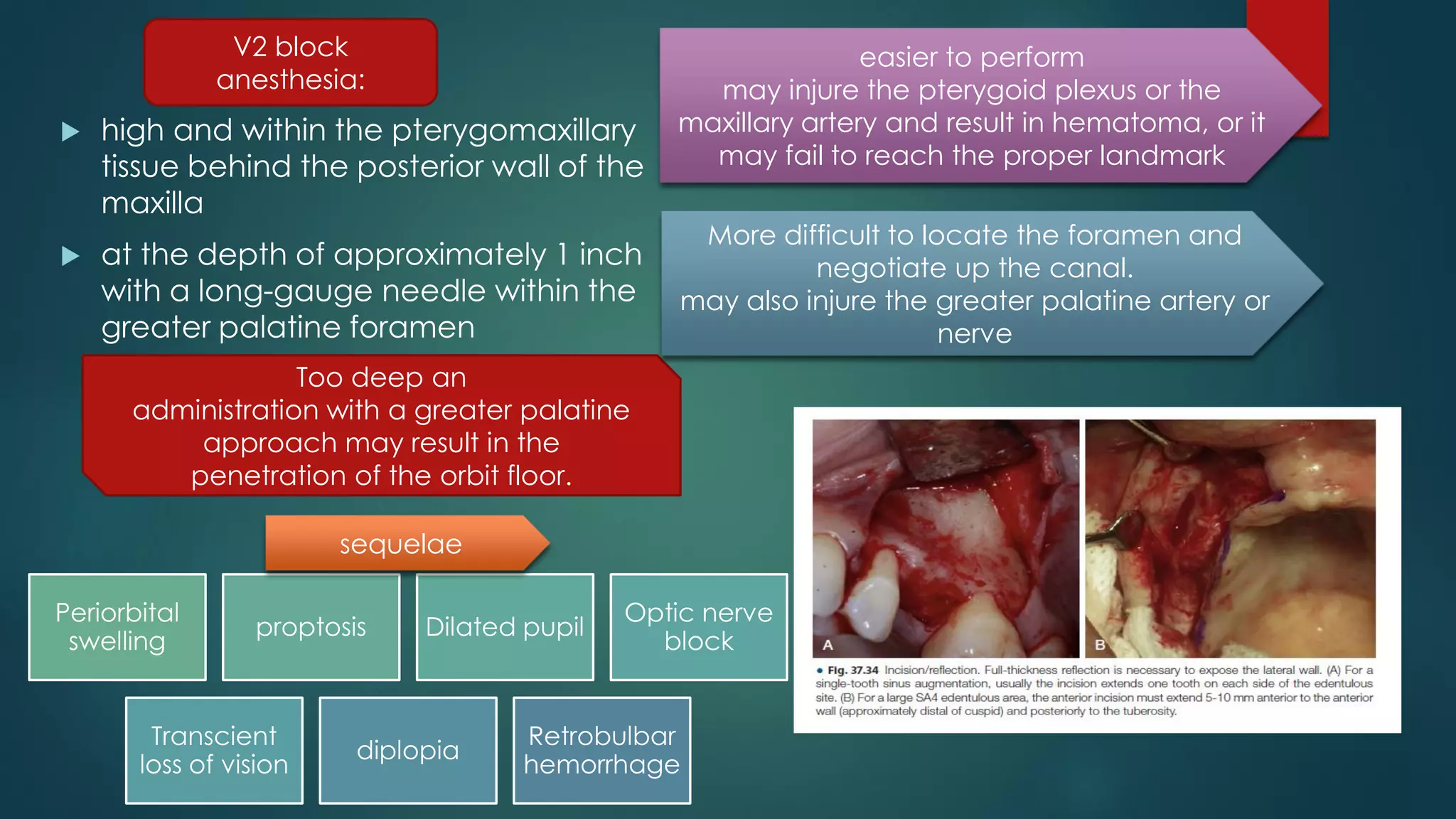 Sinus lift procedures.pptx