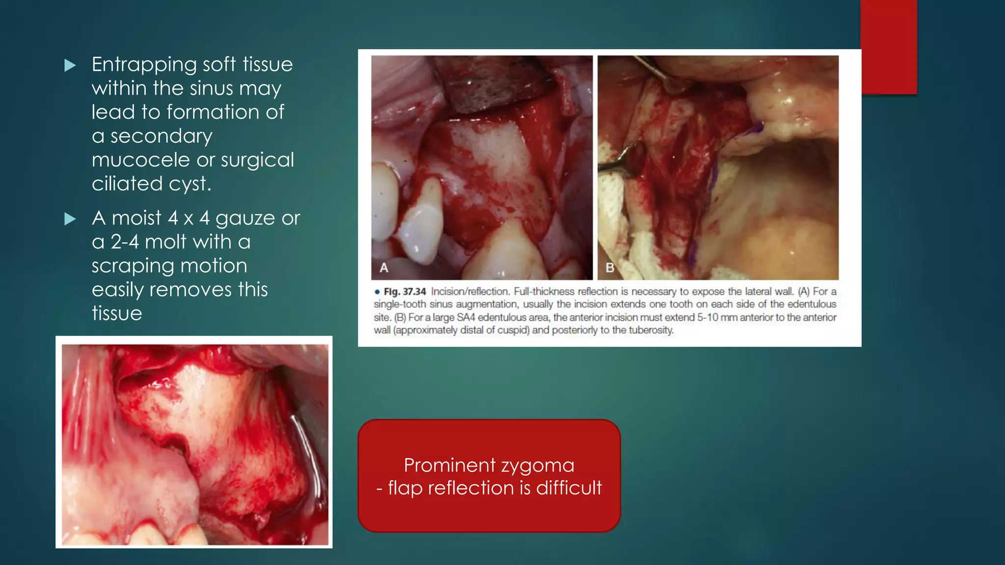 Sinus lift procedures.pptx