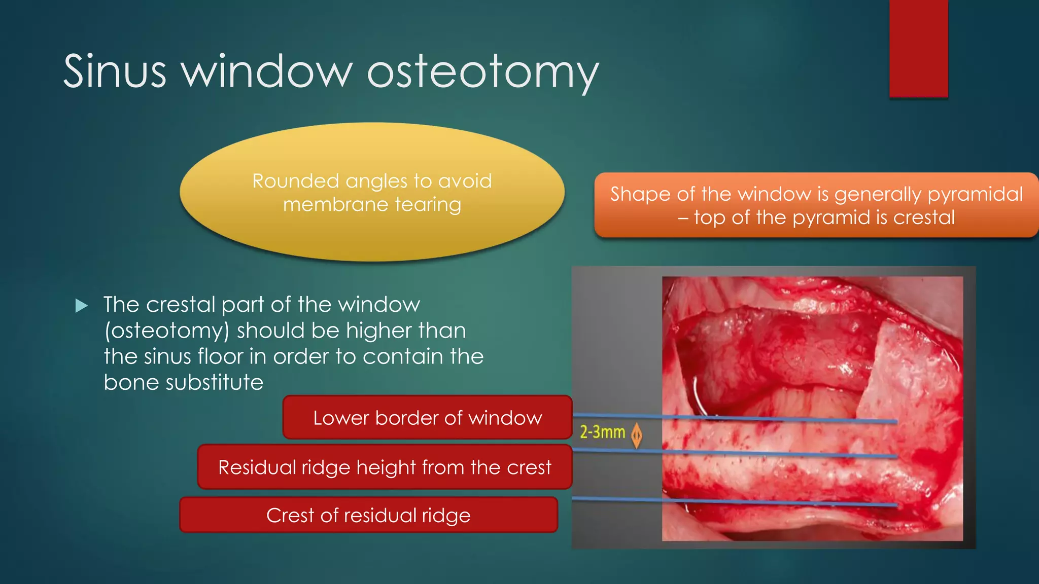 Sinus lift procedures.pptx