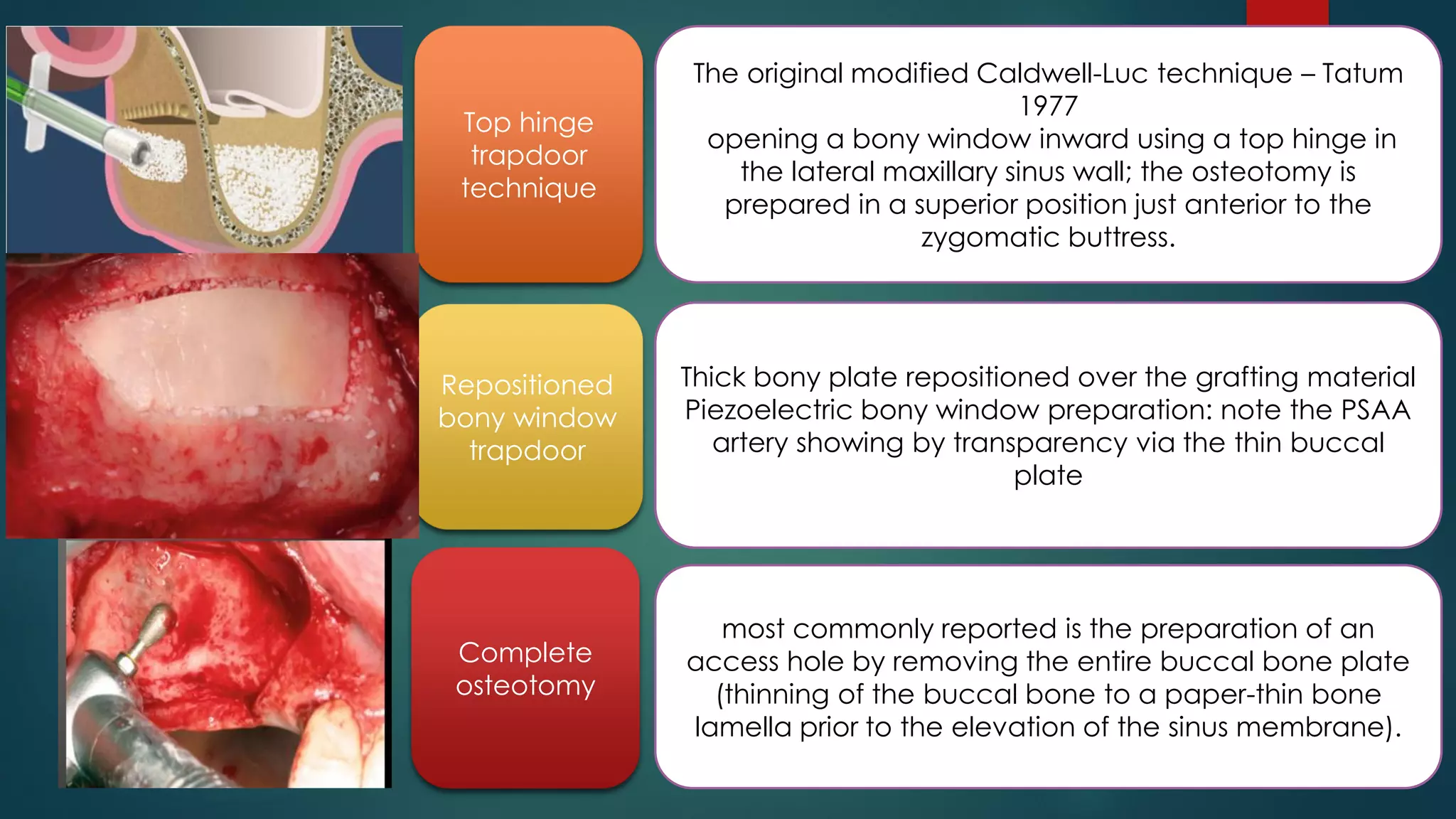 Sinus lift procedures.pptx