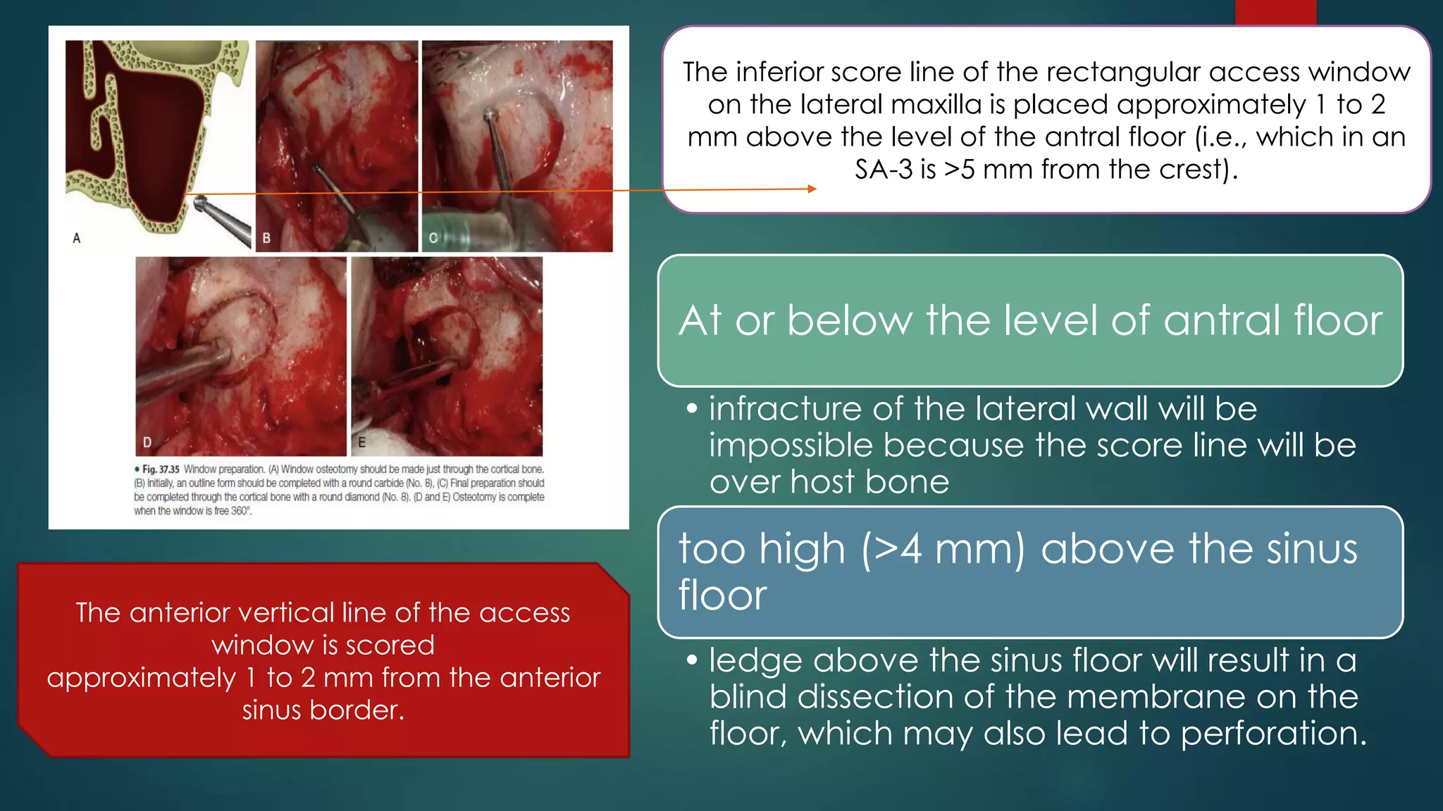 Sinus lift procedures.pptx