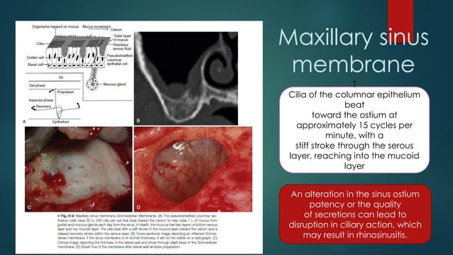 Sinus lift procedures.pptx