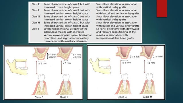 Sinus lift procedures.pptx