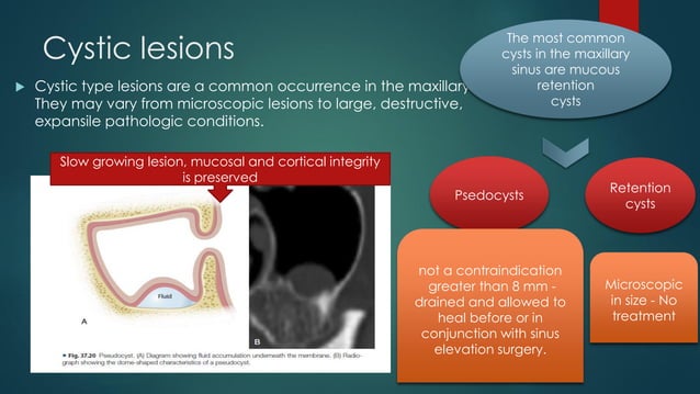 Sinus lift procedures.pptx