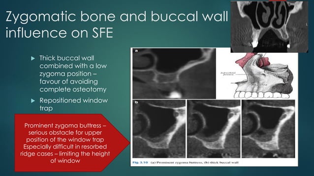 Sinus lift procedures.pptx