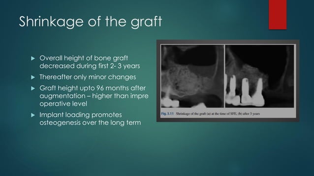 Sinus lift procedures.pptx