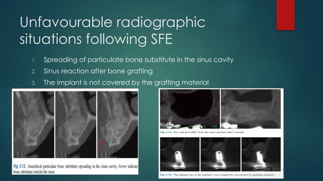 Sinus lift procedures.pptx