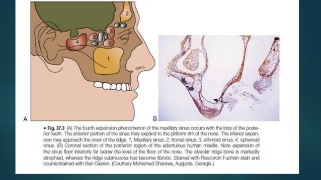 Sinus lift procedures.pptx