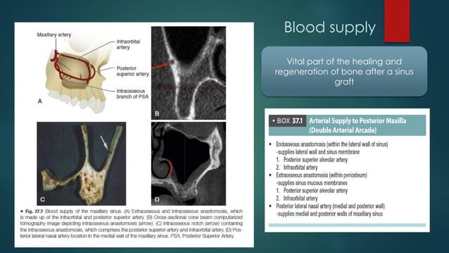 Sinus lift procedures.pptx