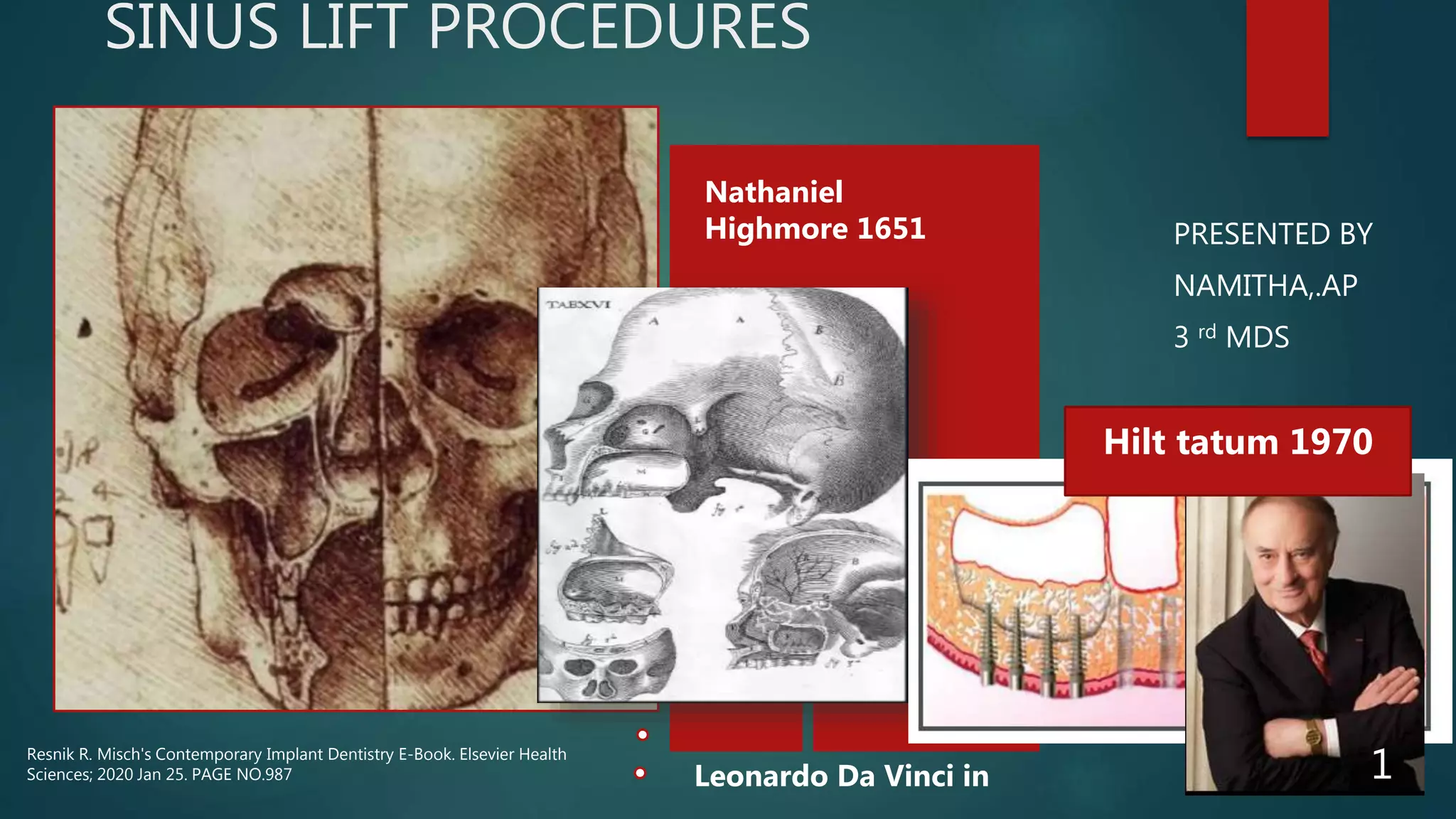 Sinus lift procedures. final copy of presentation pptx | PPTX