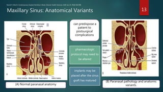 Sinus lift procedures. final copy of presentation pptx | PPTX