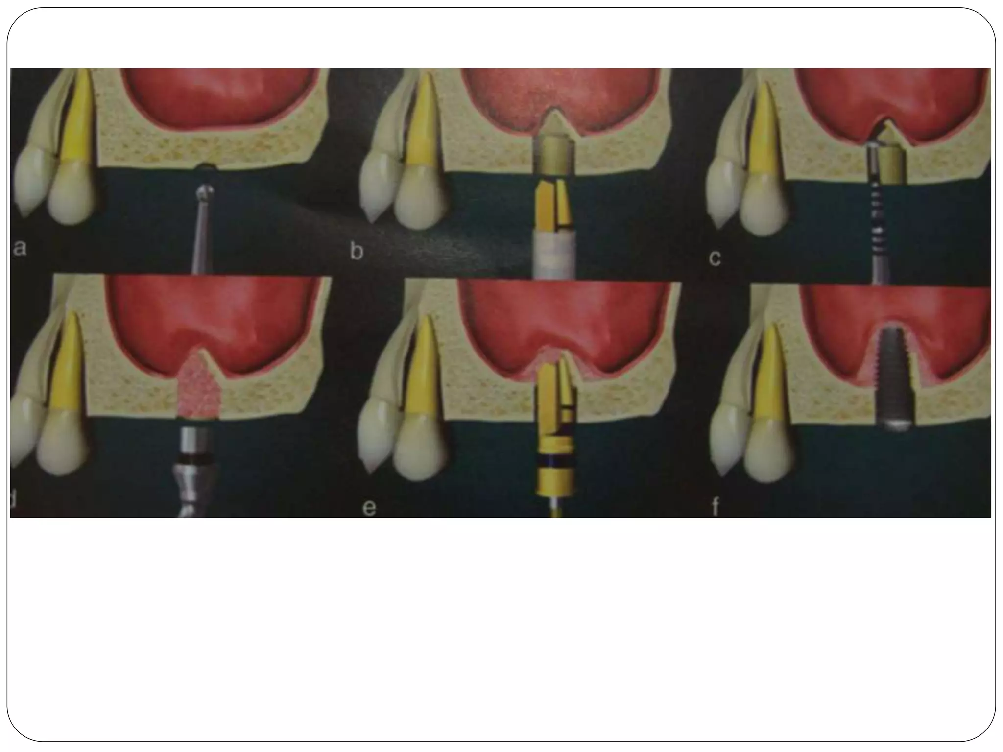Maxillary Sinus lift surgery | PPTX