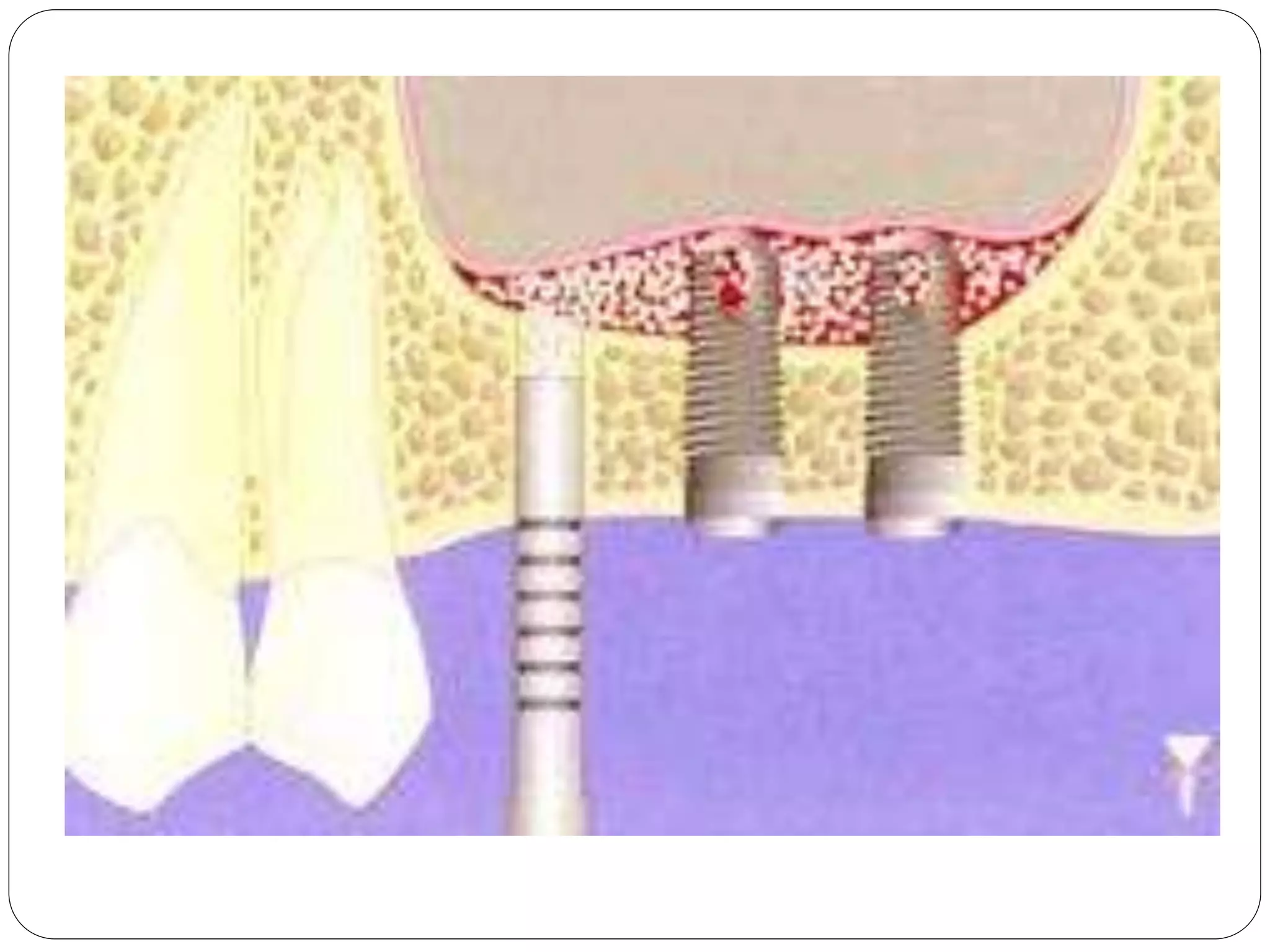 Maxillary Sinus lift surgery | PPTX