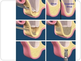 Maxillary Sinus lift surgery | PPTX