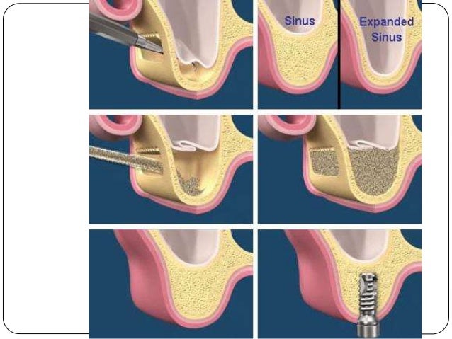 Maxillary Sinus lift surgery