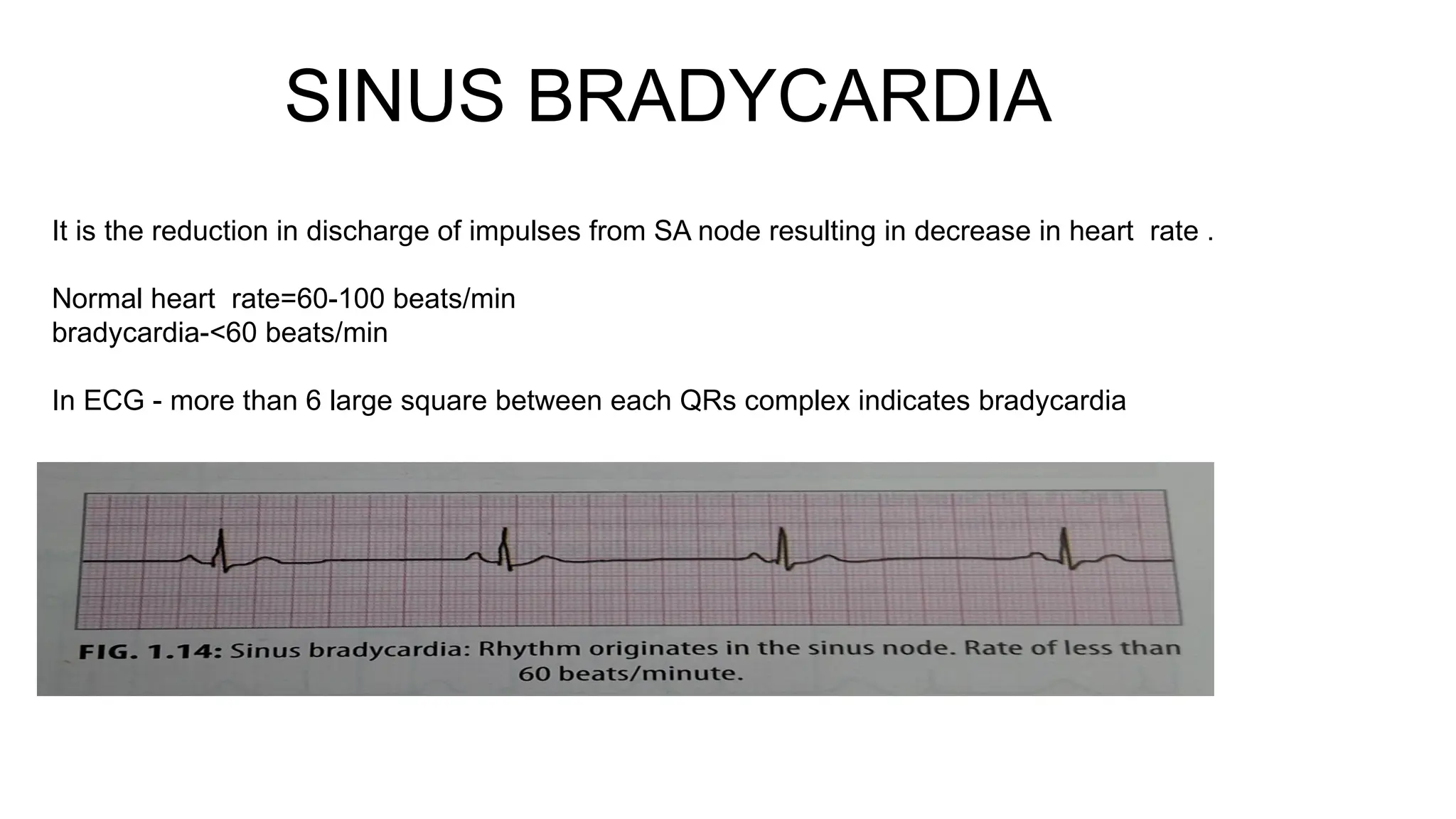 Sinus node abnormalities medicine lecture.pptx