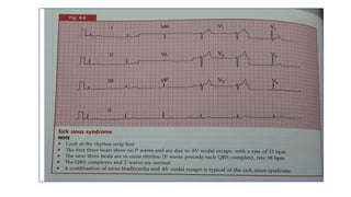 Sinus node abnormalities medicine lecture.pptx
