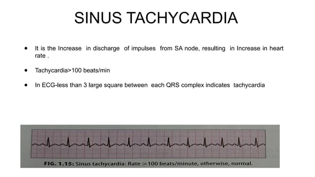 Sinus node abnormalities medicine lecture.pptx