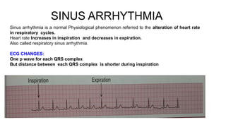 Sinus node abnormalities medicine lecture.pptx