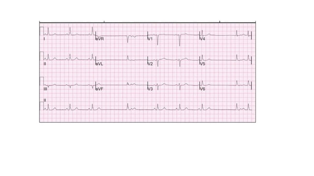 Sinus Node Dysfunction by Raashed Ramzan | PPT