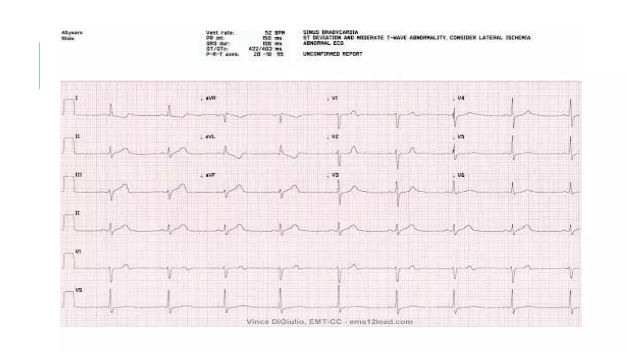 Sinus Node Dysfunction Pptx