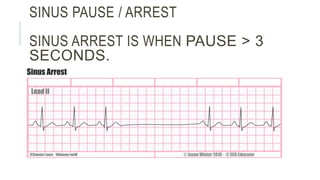 Sinus node dysfunction | PPTX | Heart and Cardiovascular Diseases ...