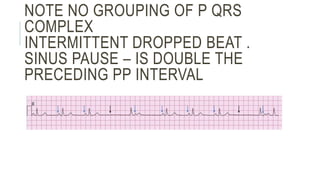 Sinus node dysfunction | PPTX | Heart and Cardiovascular Diseases ...