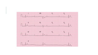Sinus node dysfunction | PPTX | Heart and Cardiovascular Diseases ...