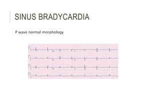 Sinus node dysfunction | PPTX | Heart and Cardiovascular Diseases ...