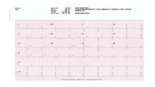 Sinus node dysfunction | PPTX | Heart and Cardiovascular Diseases ...