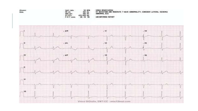Sinus node dysfunction | PPTX | Heart and Cardiovascular Diseases ...