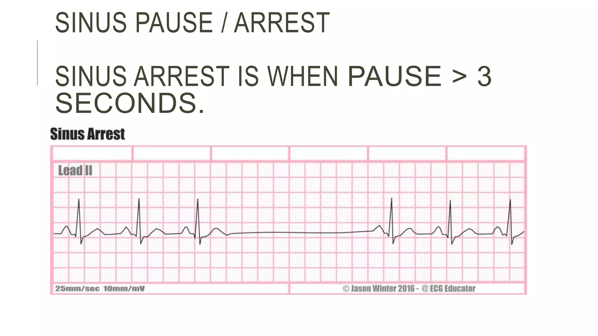 Sinus node dysfunction | PPTX