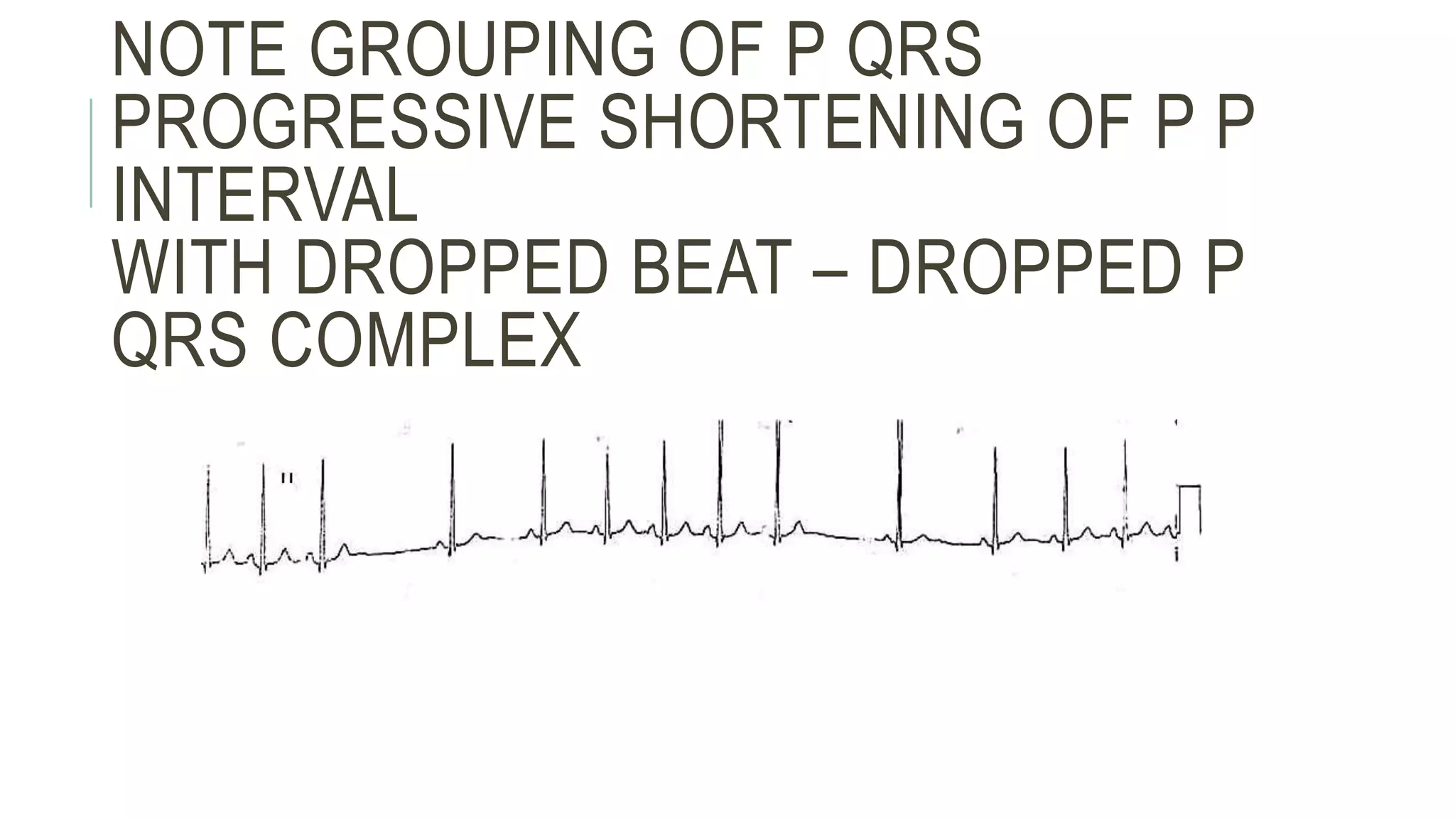 Sinus node dysfunction | PPTX