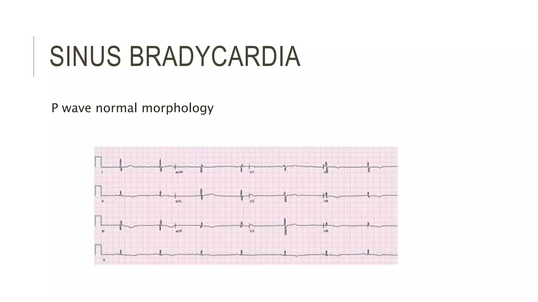 Sinus Node Dysfunction Pptx