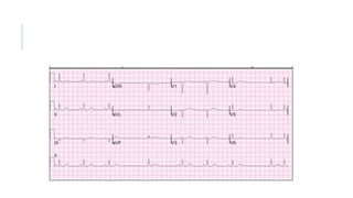 Sinus node dysfunction | PPTX