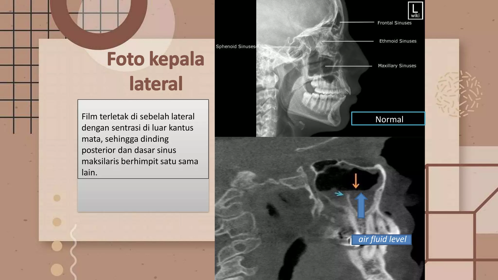 SINUS PARANASAL.pptx