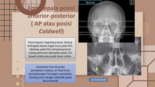 SINUS PARANASAL.pptx