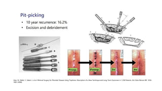 Sinus pilonidalis lokale behandeling en nieuwe richtlijn | PPT